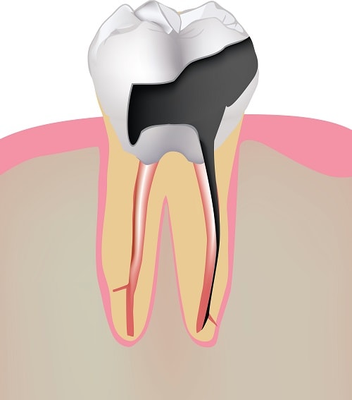 molare con radice.e carie - Dental Implants in Havre de Grace, MD